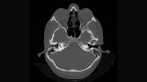 A Clear Picture: How Sinus CT Scans Transform Lives
